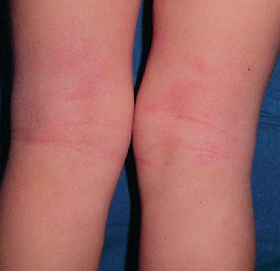 Como curar las rozaduras entre las piernas - Eternalia